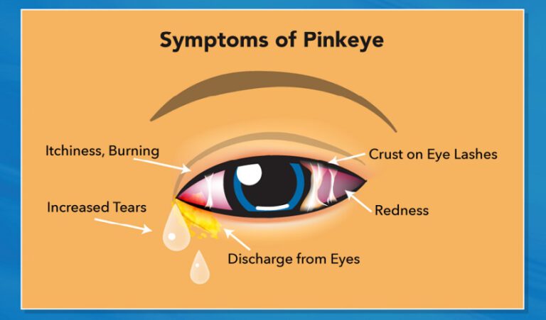 Ten Best Home Remedies For Pink Eye (Conjunctivitis)